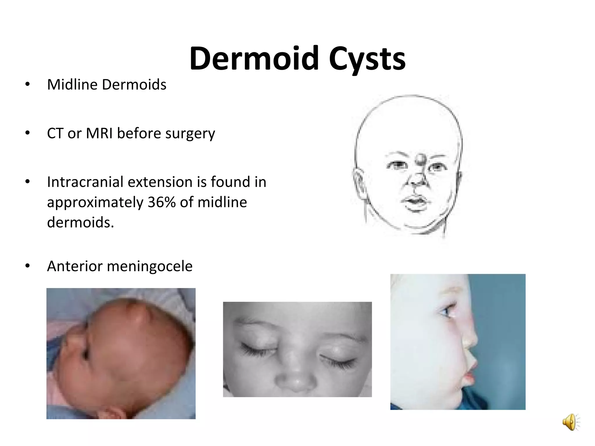 Dermoid & Epidermoid Cysts | PPT