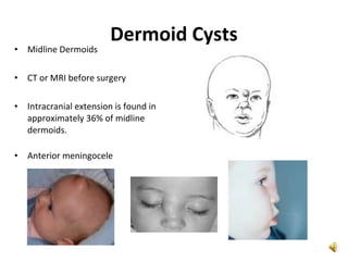 Dermoid & Epidermoid Cysts | PPT