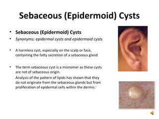 Infected Epidermal Inclusion Cyst (Sebaceous Cyst) Of The, 49% OFF