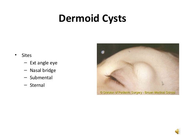 Epidermoid Cyst Intratesticular Benign Epidermoid Cyst