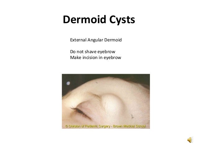 Dermoid And Epidermoid Cysts
