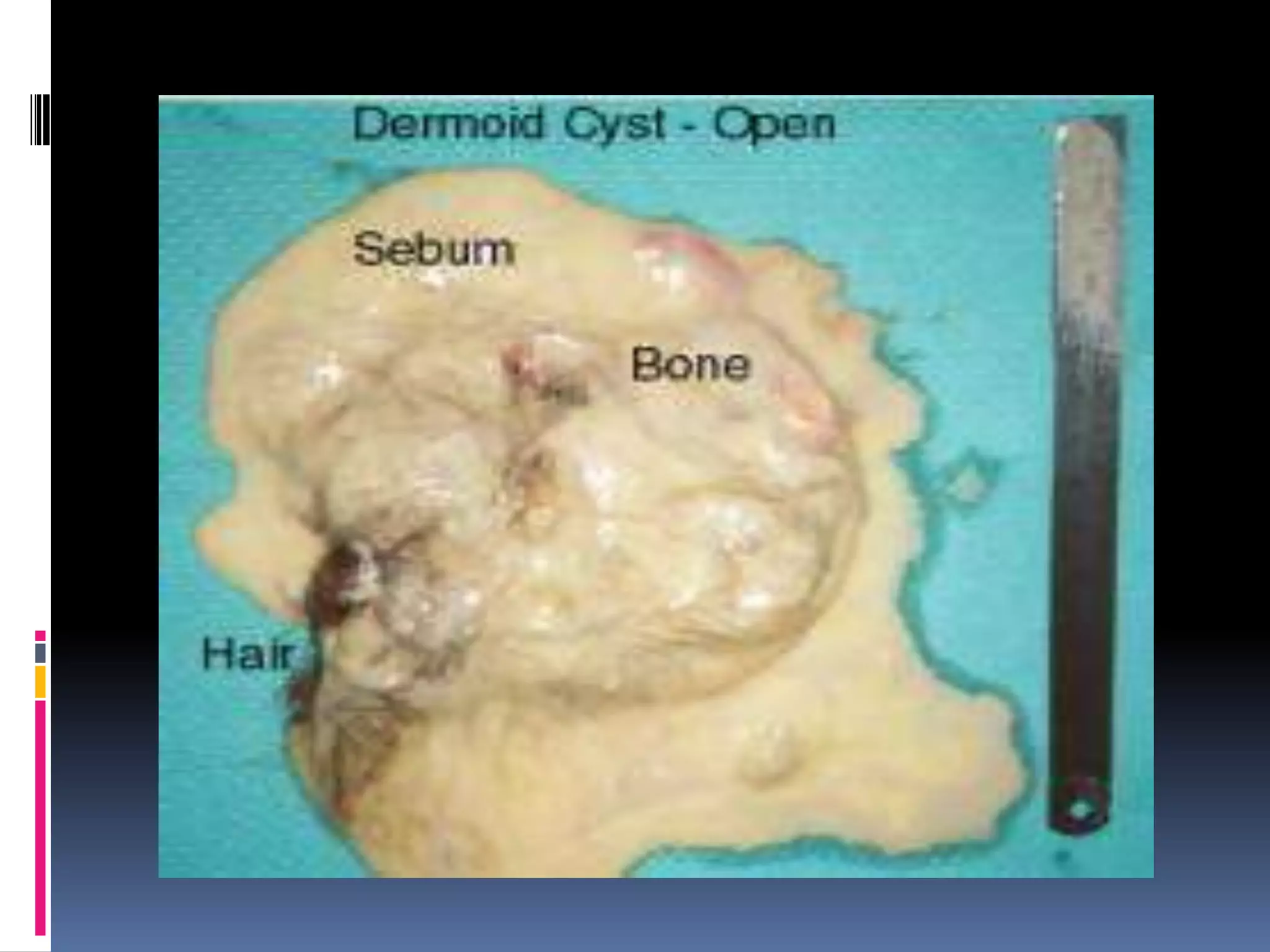 Dermoid cyst | PPTX