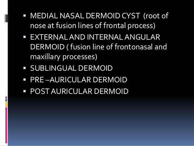 Dermoid Cyst