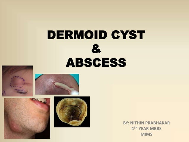 Dermoid cyst | PPTX