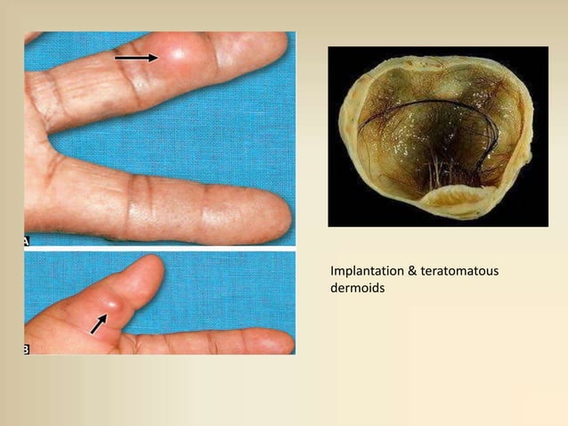 Dermoid cyst | PPTX