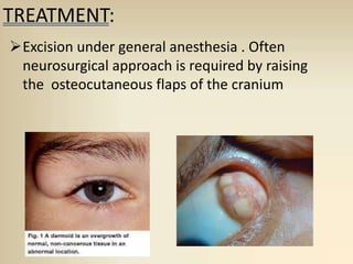 Dermoid cyst | PPTX
