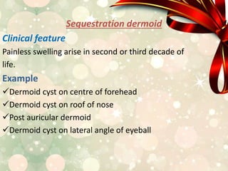 Dermoid cyst by momen | PPTX
