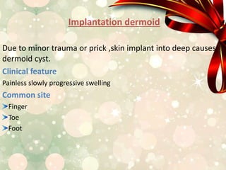 Dermoid cyst by momen | PPTX