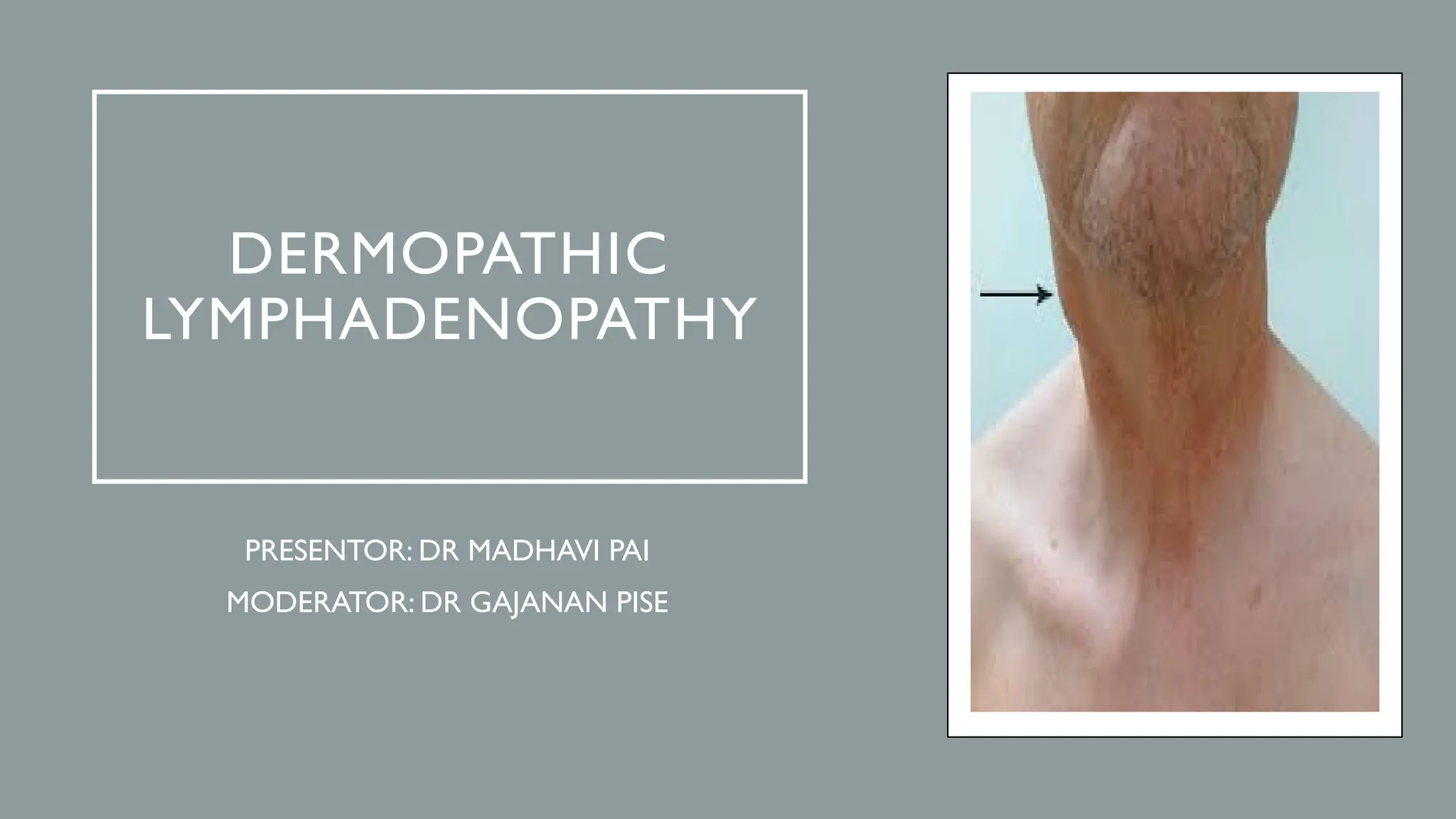 Dermopathic lymphadenopathy- causes and evaluation | PPTX