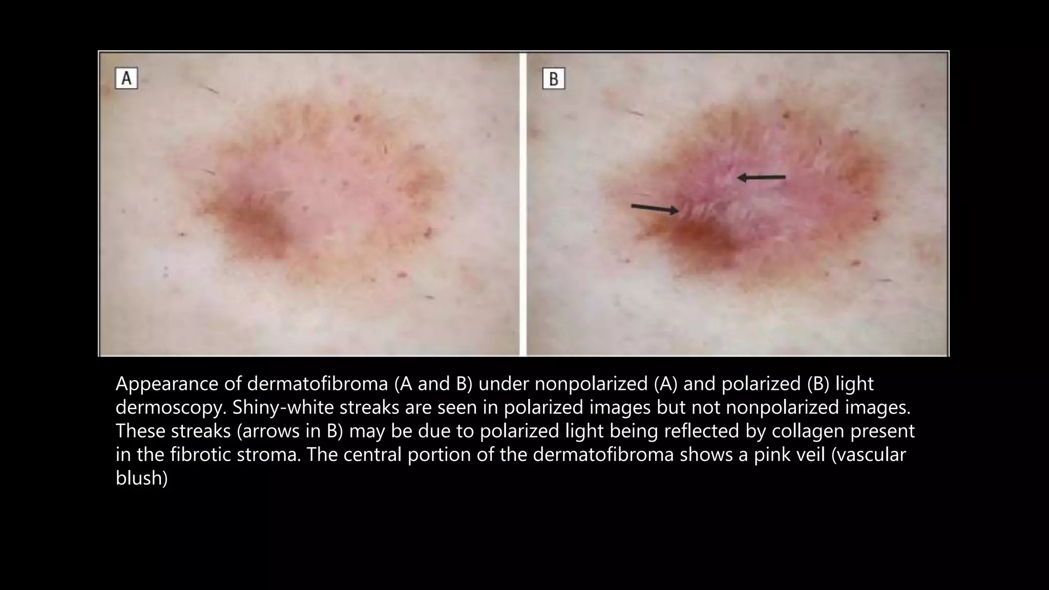 Dermoscopy an overview | PPTX