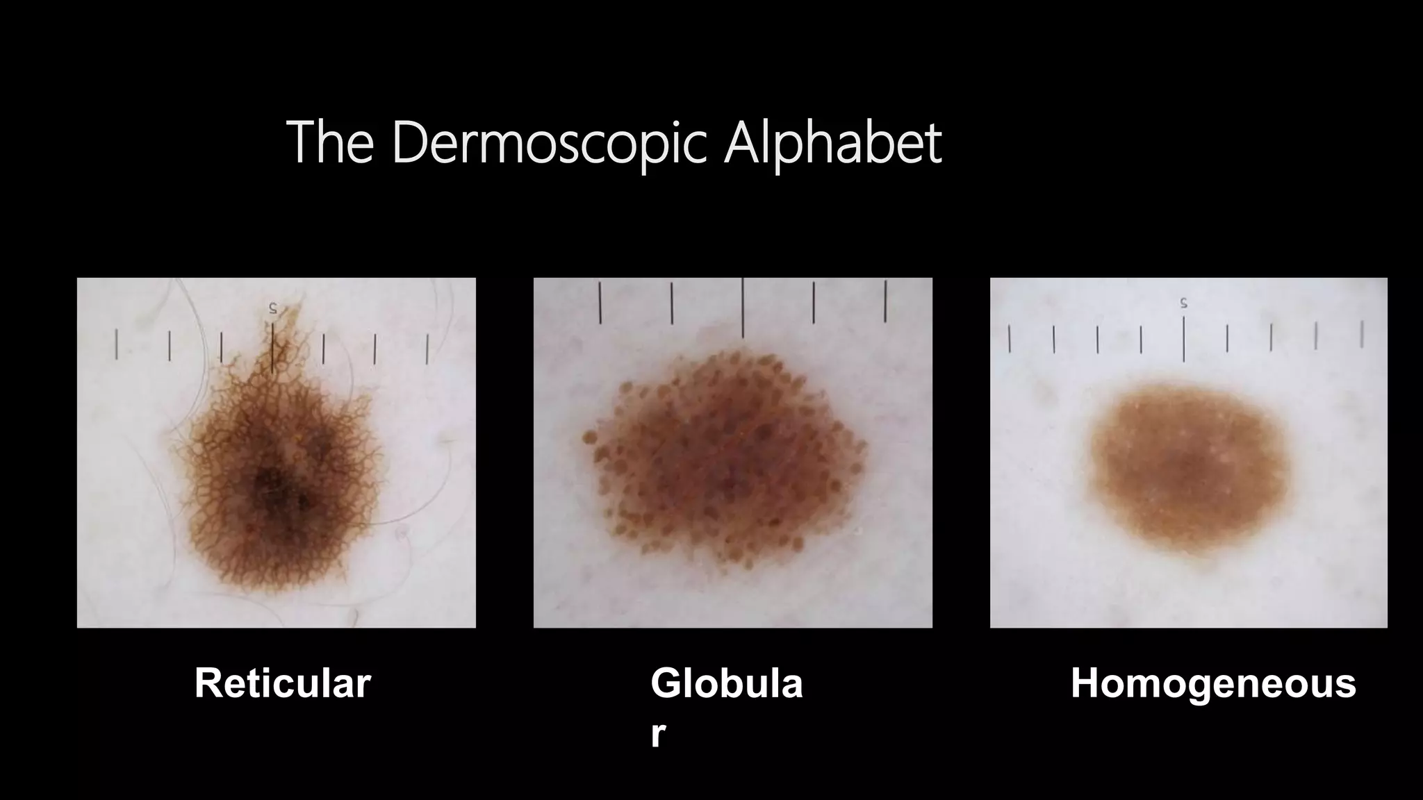 Dermoscopy an overview | PPTX | Skin and Dermatology | Diseases and ...