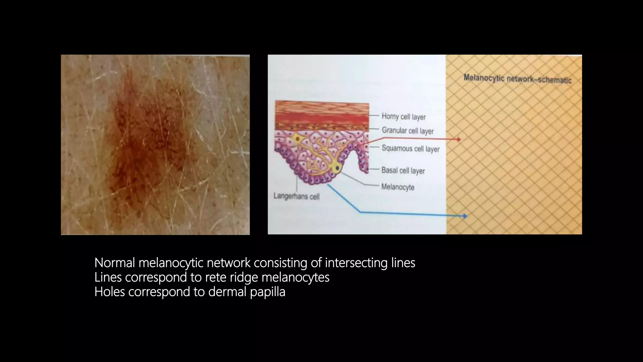Dermoscopy an overview | PPTX | Skin and Dermatology | Diseases and ...