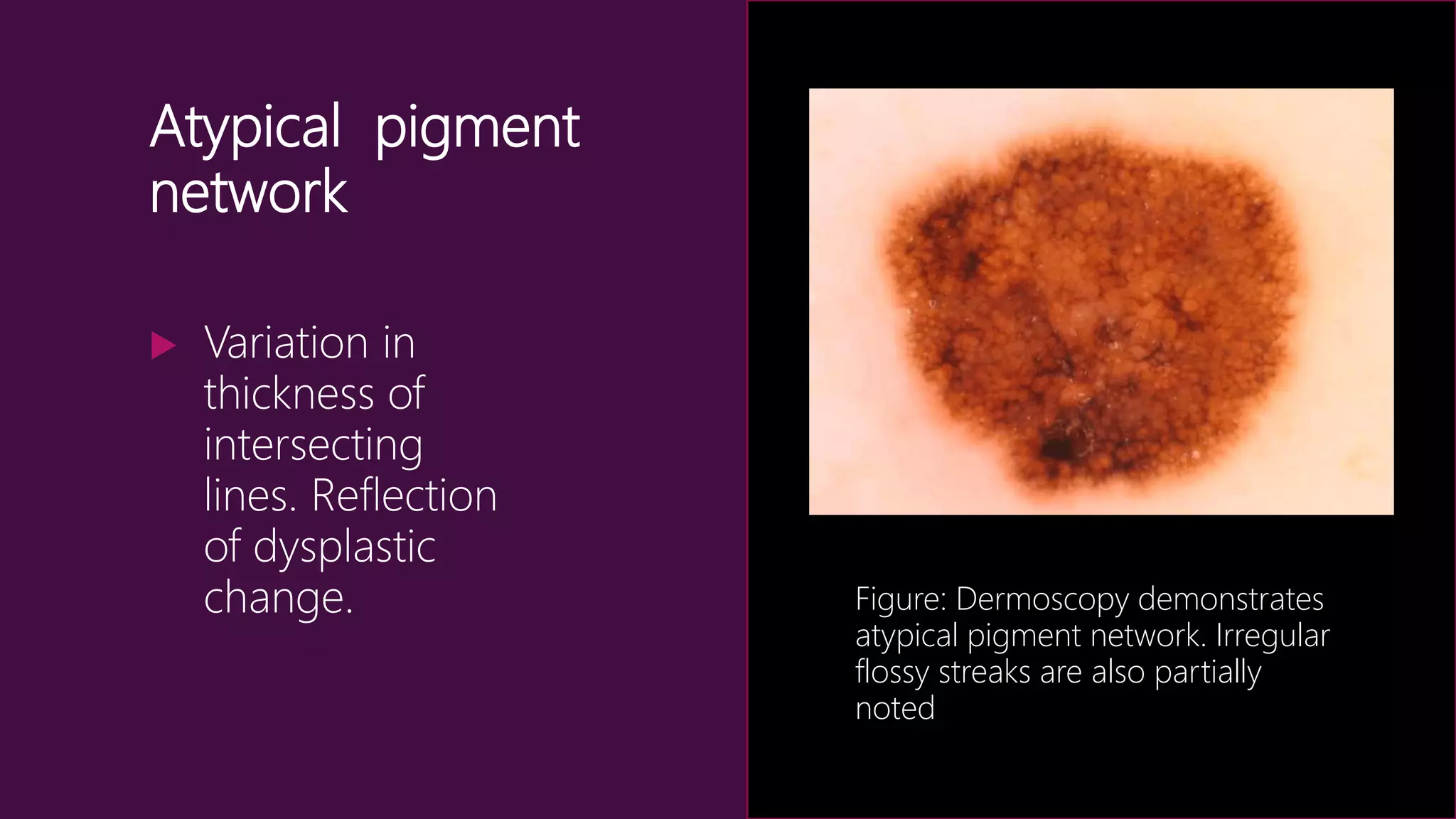 Dermoscopy an overview | PPTX | Skin and Dermatology | Diseases and ...