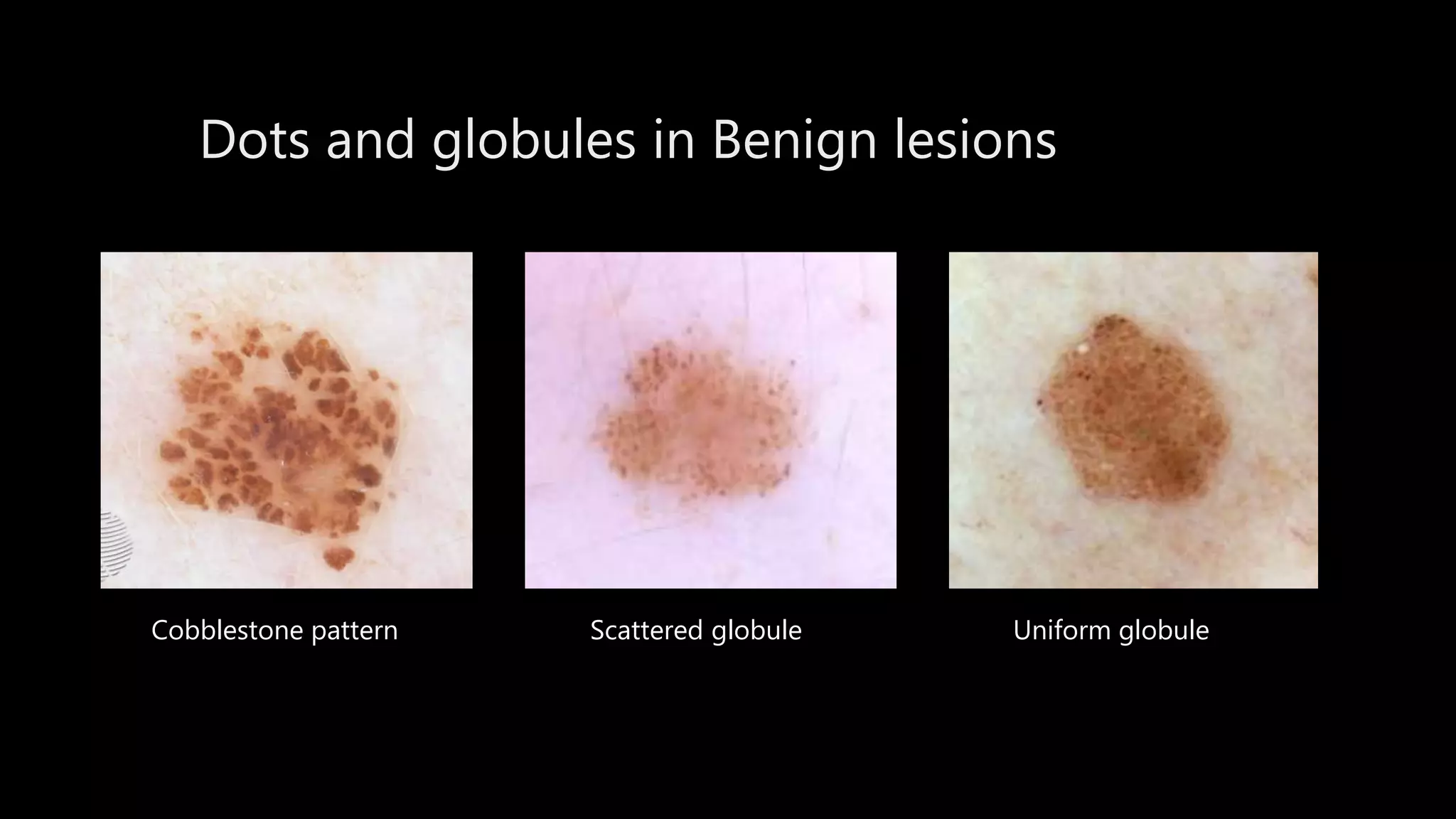 Dermoscopy an overview | PPTX