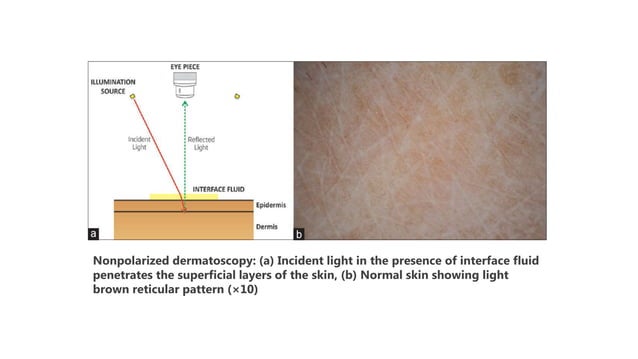 Dermoscopy an overview | PPTX | Skin and Dermatology | Diseases and ...