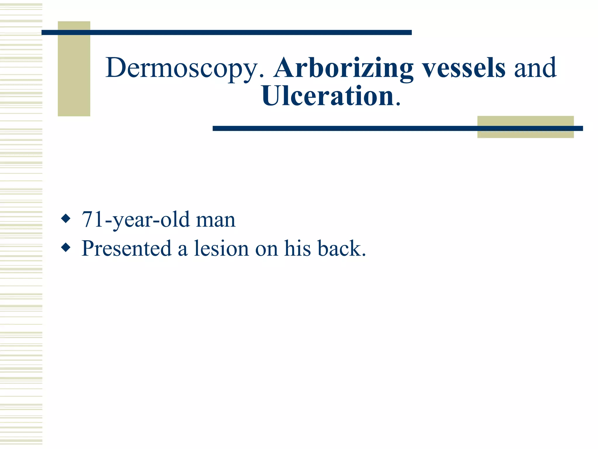 Dermoscopy Arborizing Vessels And Ulceration | PPT