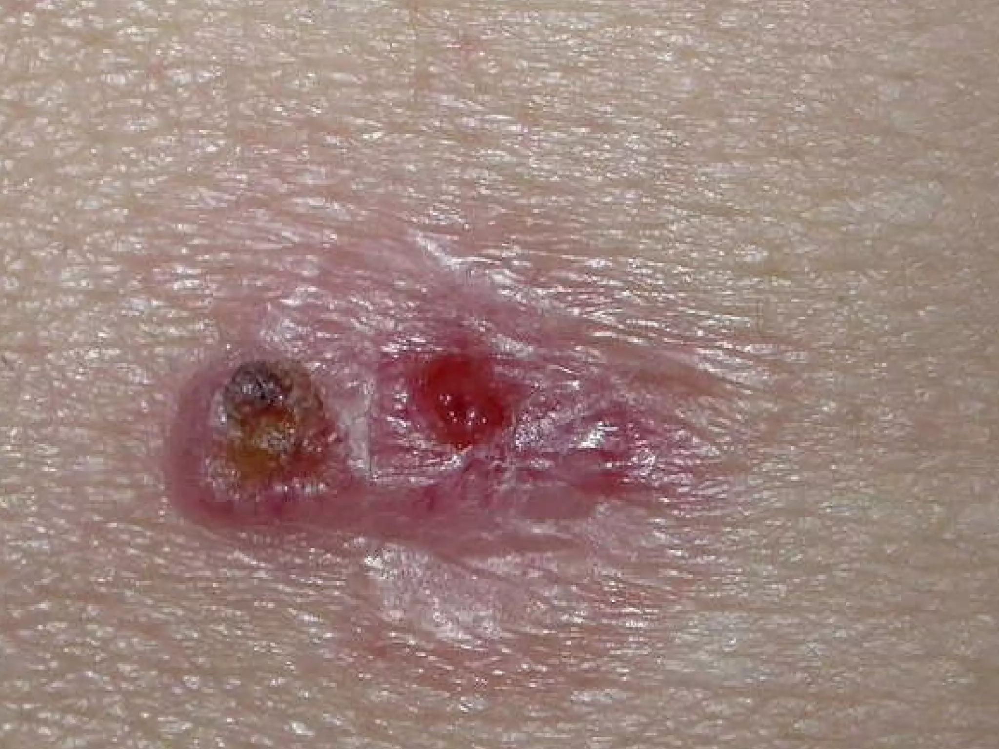 Dermoscopy Arborizing Vessels And Ulceration | PPT