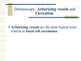 Dermoscopy Arborizing Vessels And Ulceration | PPT