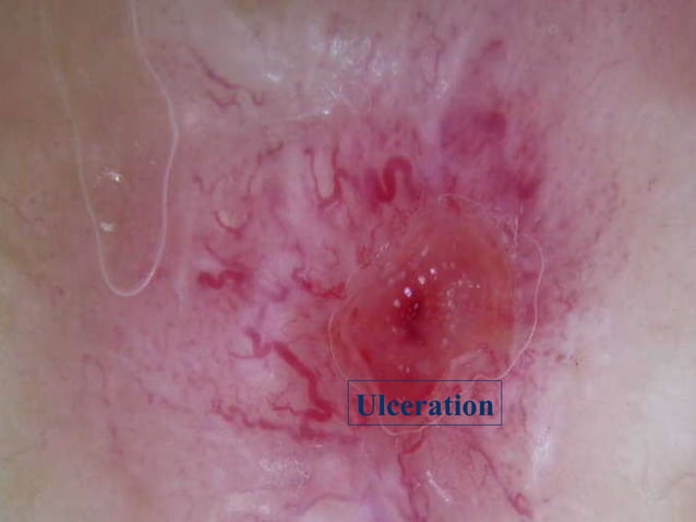Dermoscopy Arborizing Vessels And Ulceration | PPT