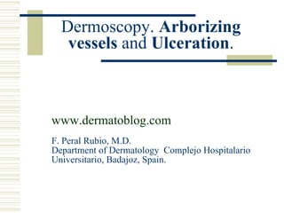 Dermoscopy Arborizing Vessels And Ulceration | PPT