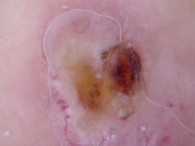 Dermoscopy Arborizing Vessels And Ulceration | PPT