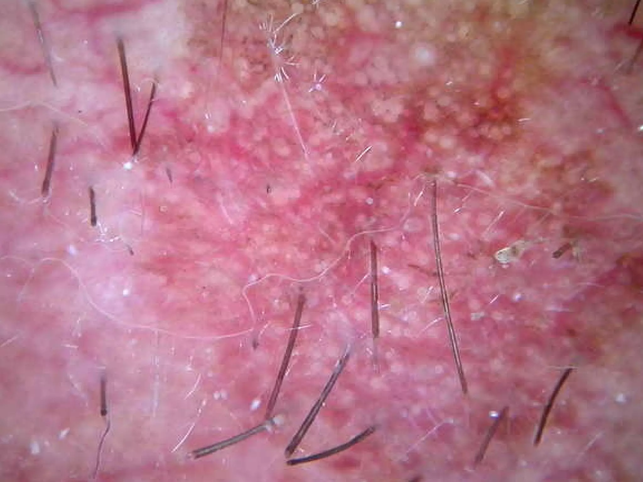 Dermoscopy. pigmented lesion on the cheek | PPT