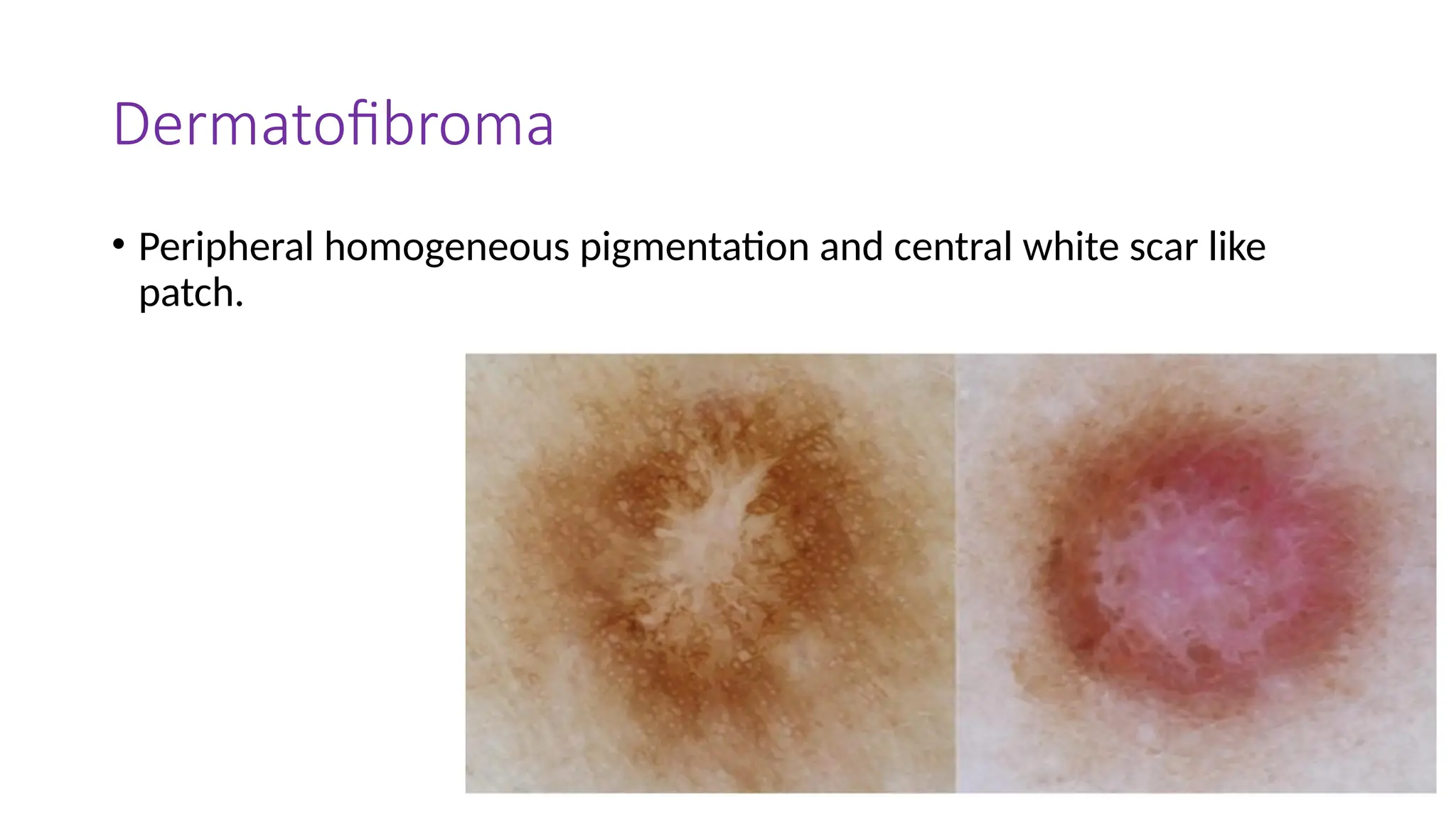 Dermoscopy in various skin disorders.pptx