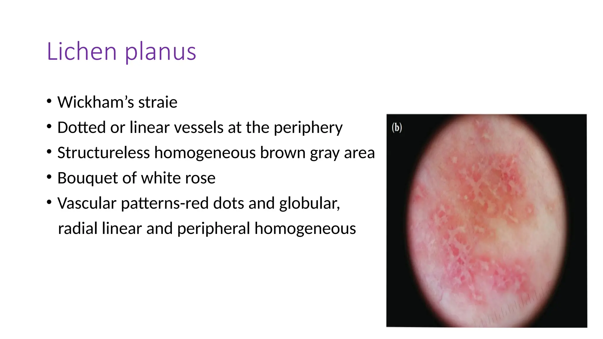 Dermoscopy in various skin disorders.pptx