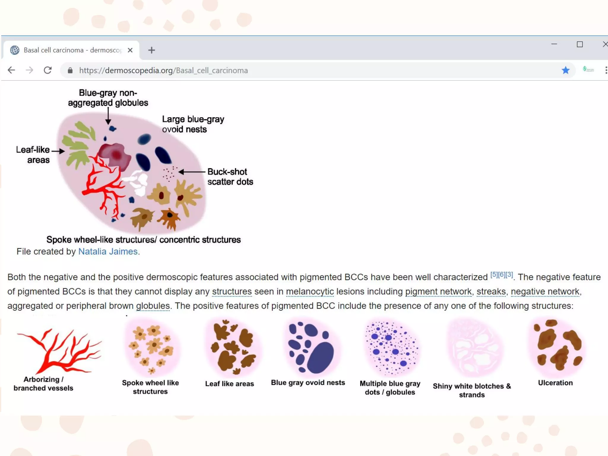 Dermoscopy _BCC_M_Bosseila_2018 | PDF