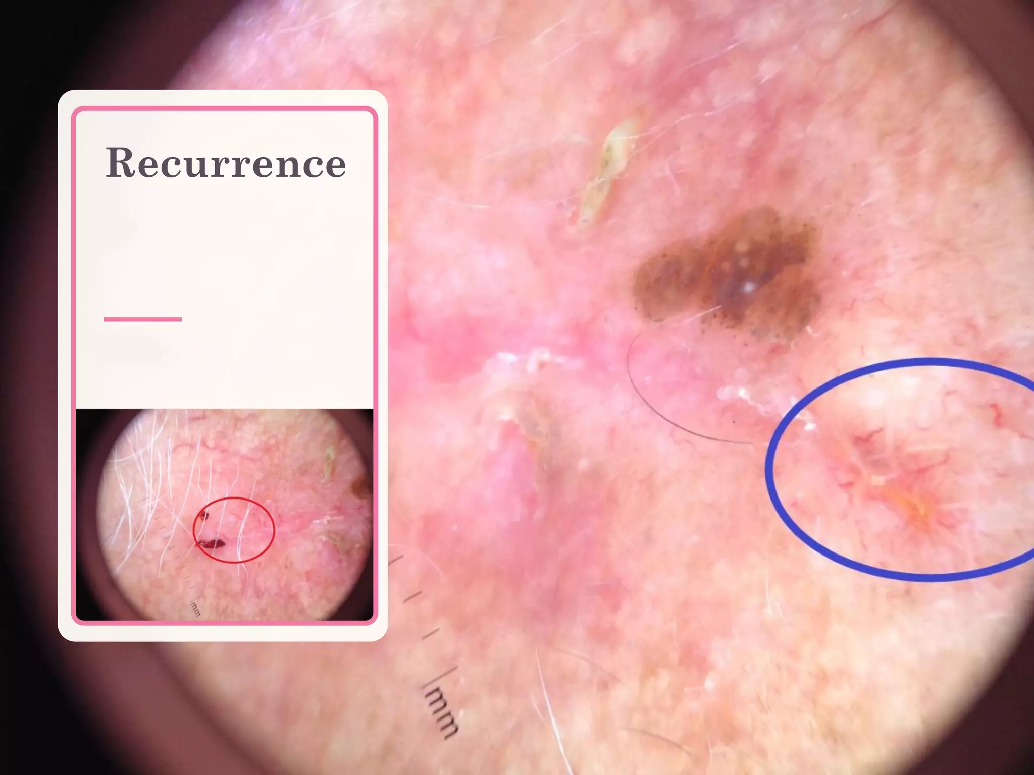 Dermoscopy _BCC_M_Bosseila_2018 | PPT