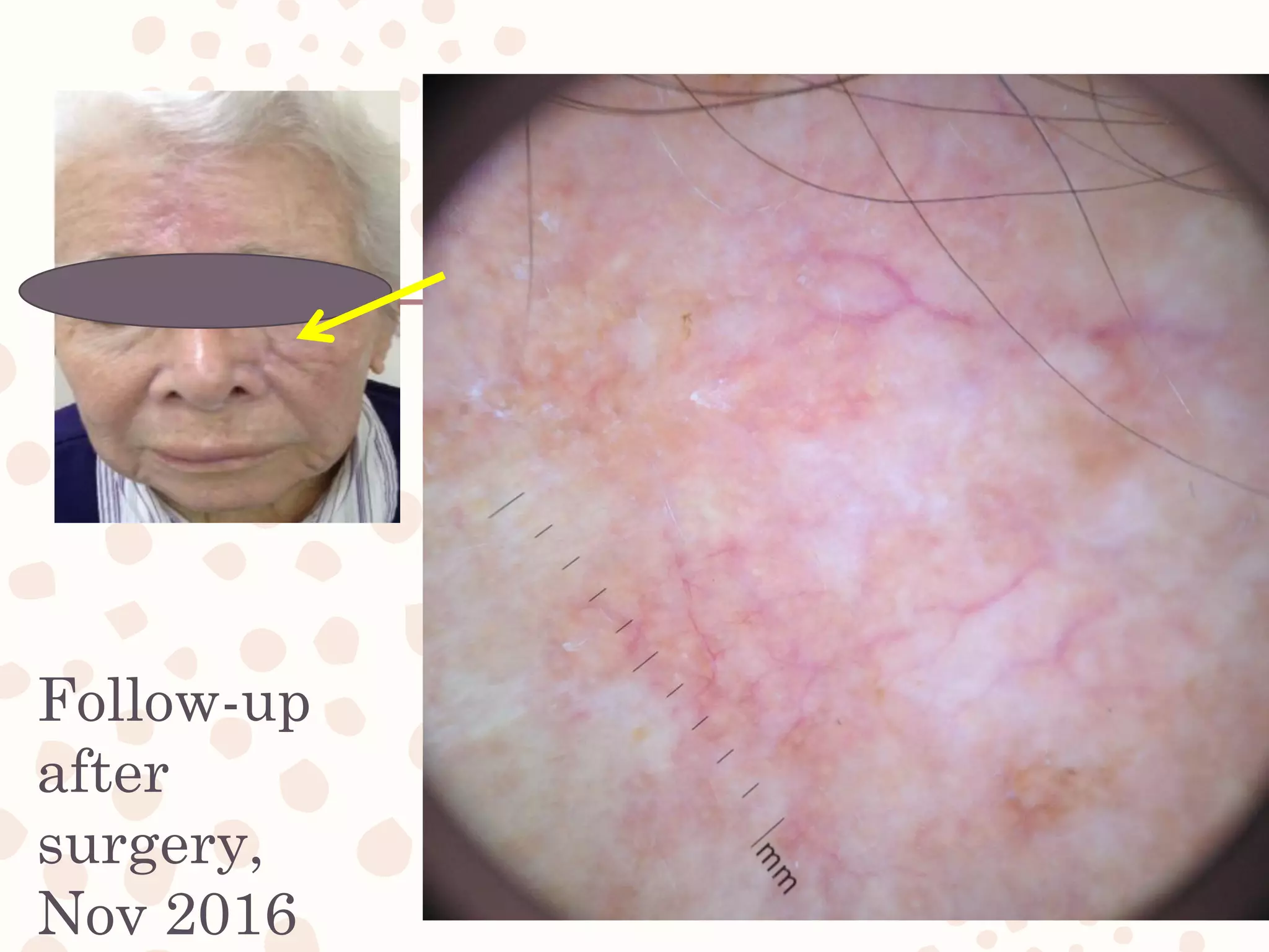 Dermoscopy _BCC_M_Bosseila_2018 | PPT