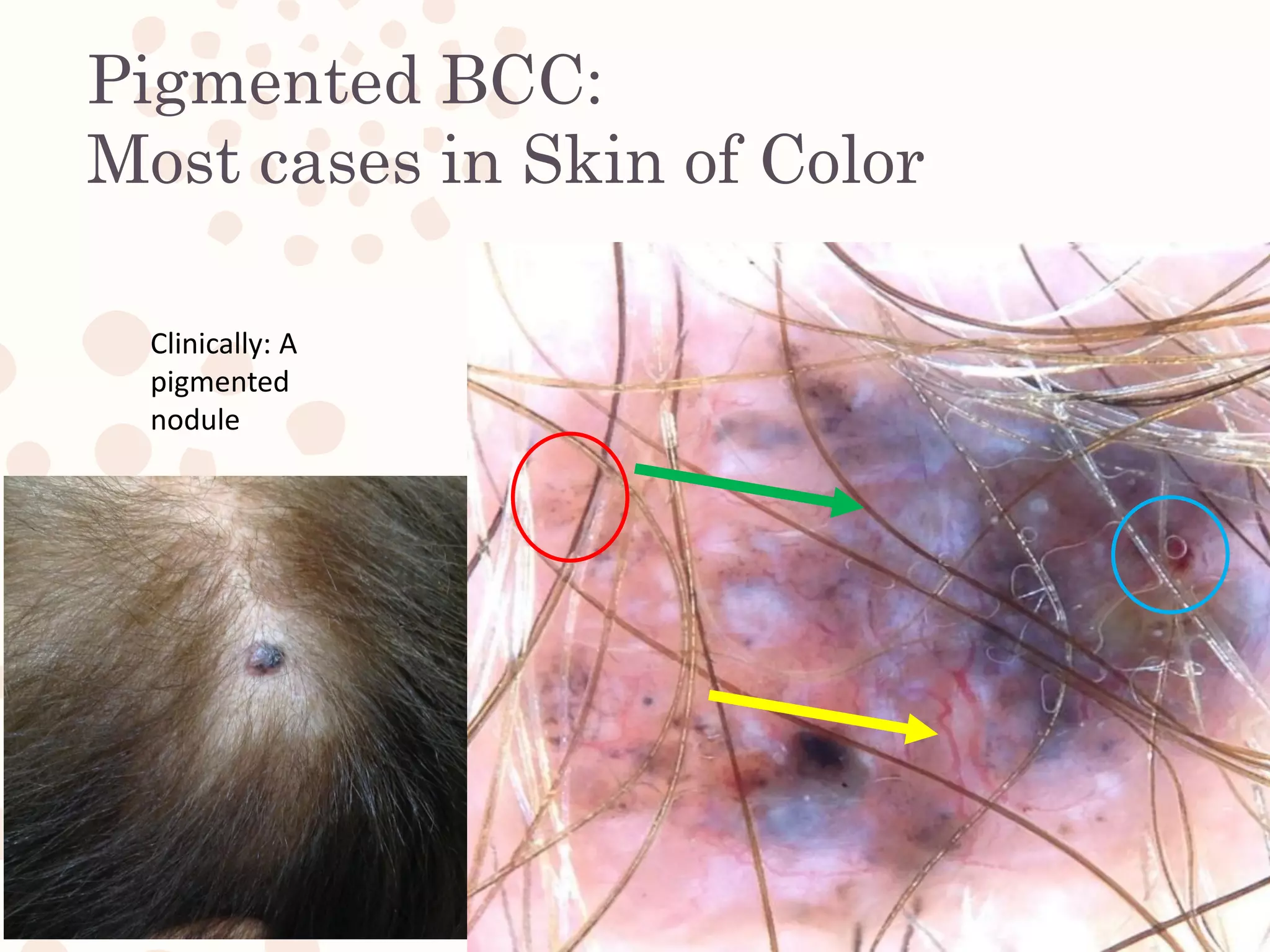 Dermoscopy _BCC_M_Bosseila_2018 | PDF
