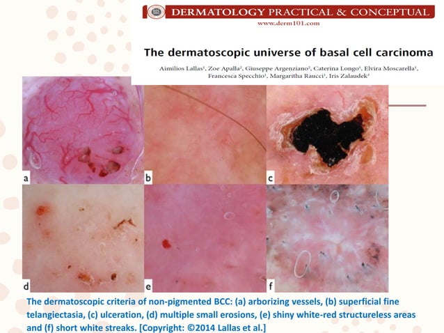 Dermoscopy _BCC_M_Bosseila_2018 | PPT