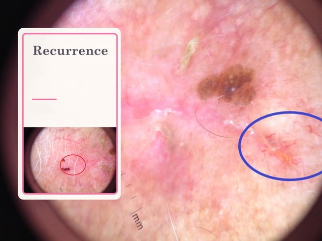 Dermoscopy _BCC_M_Bosseila_2018 | PPT