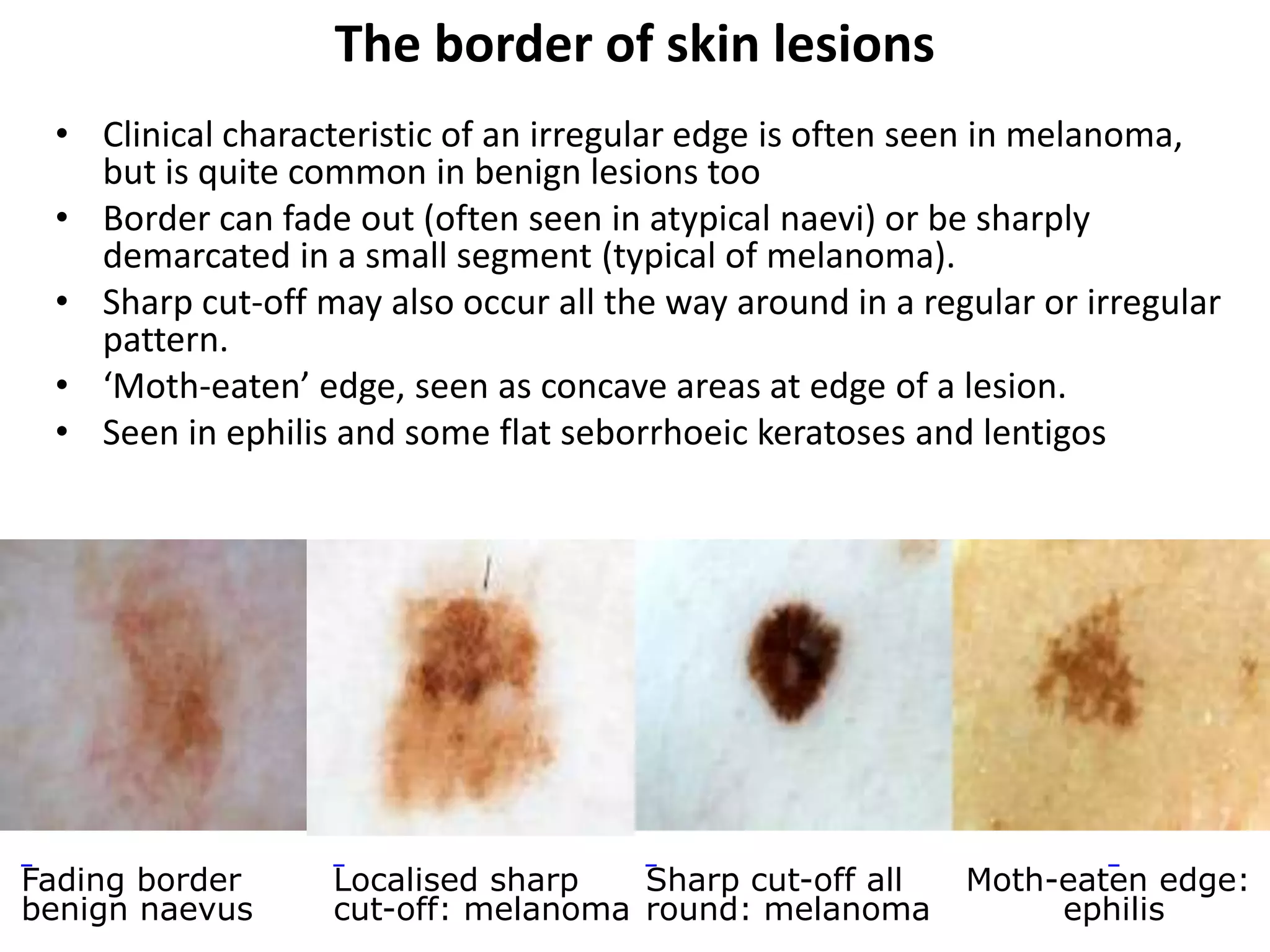 Dermoscopy pigment vs vascular | PPTX