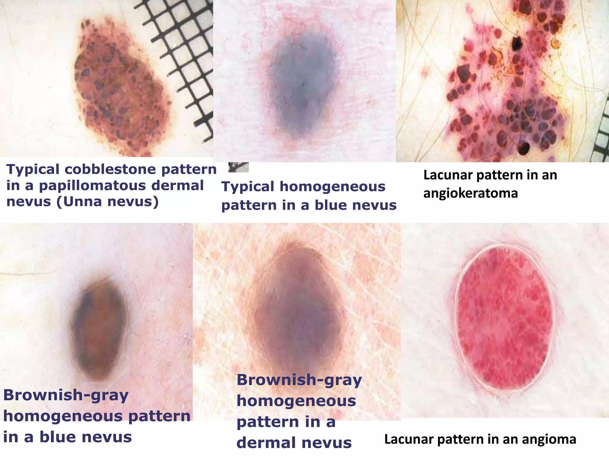 Dermoscopy pigment vs vascular | PPTX