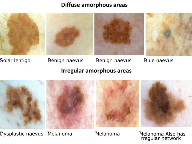 Dermoscopy pigment vs vascular | PPT