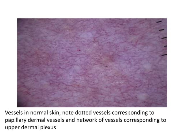 Dermoscopy pigment vs vascular | PPTX