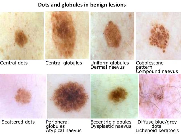 Dermoscopy pigment vs vascular
