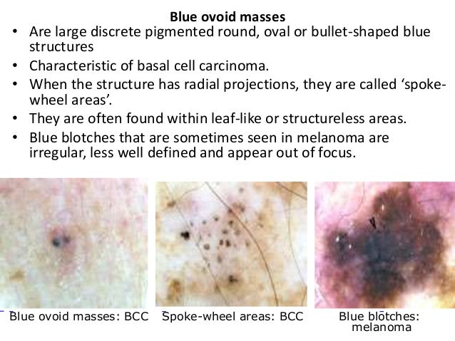 Dermoscopy pigment vs vascular