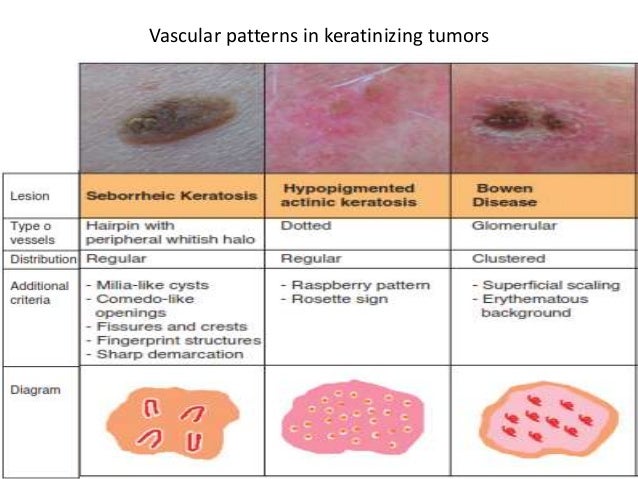 Dermoscopy pigment vs vascular