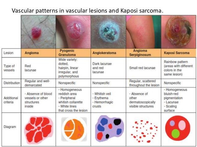 Dermoscopy pigment vs vascular
