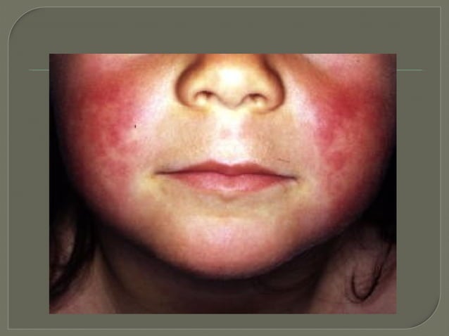 Paediatric Rashes | PPT | Infectious Diseases | Diseases and Conditions