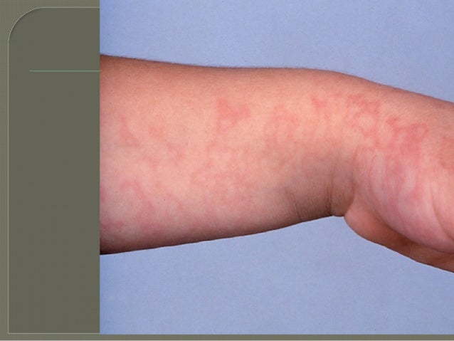 Paediatric Rashes