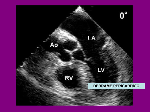 Derrame Pericardico | PPT