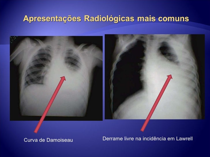 Derrame pleural parapneumonico