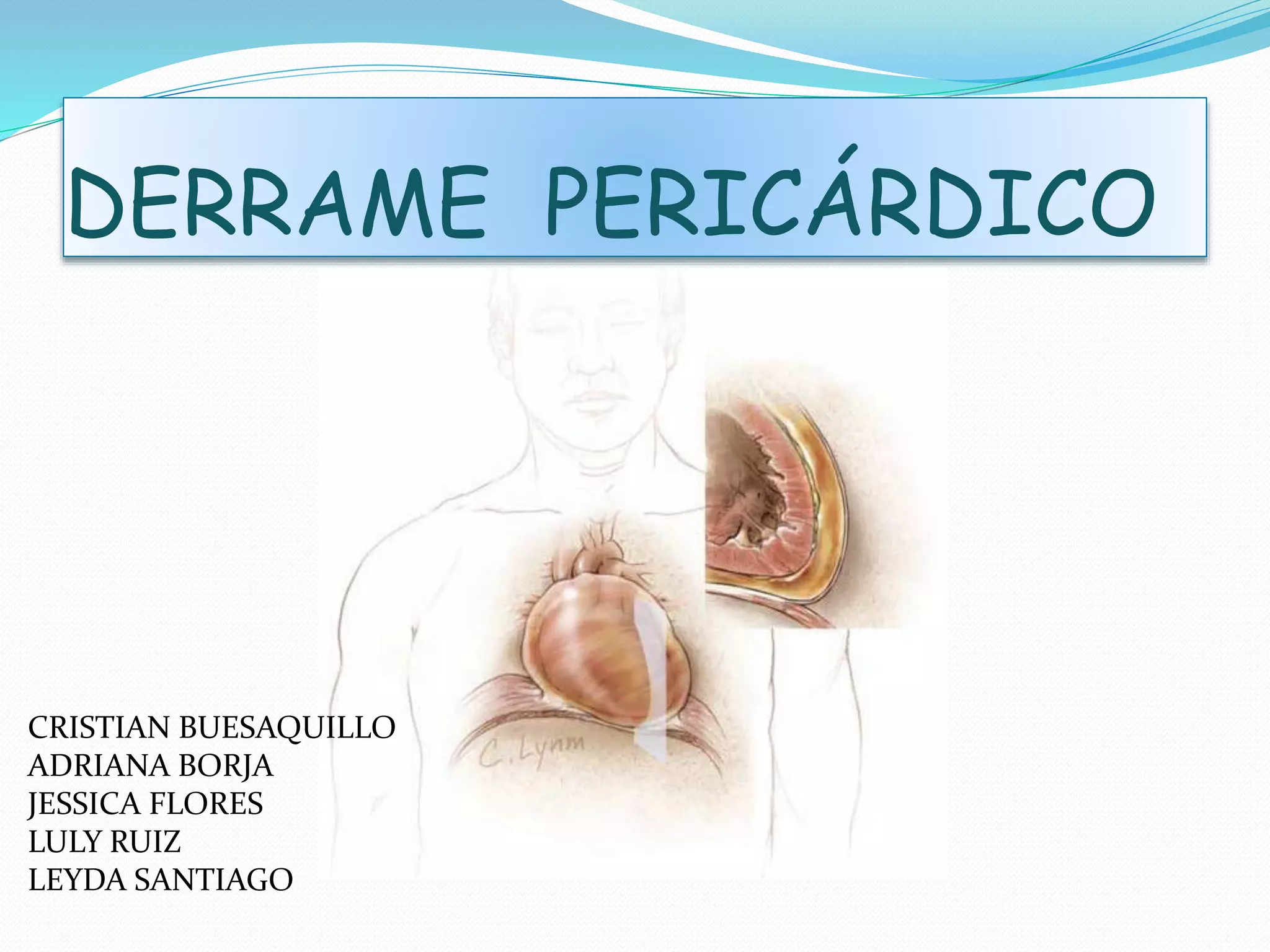 Derrame pericardico | PPTX