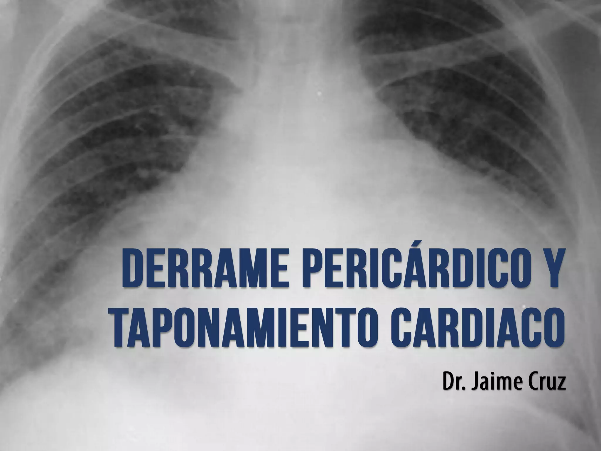 Derrame pericardico y taponamiento cardiaco | PDF
