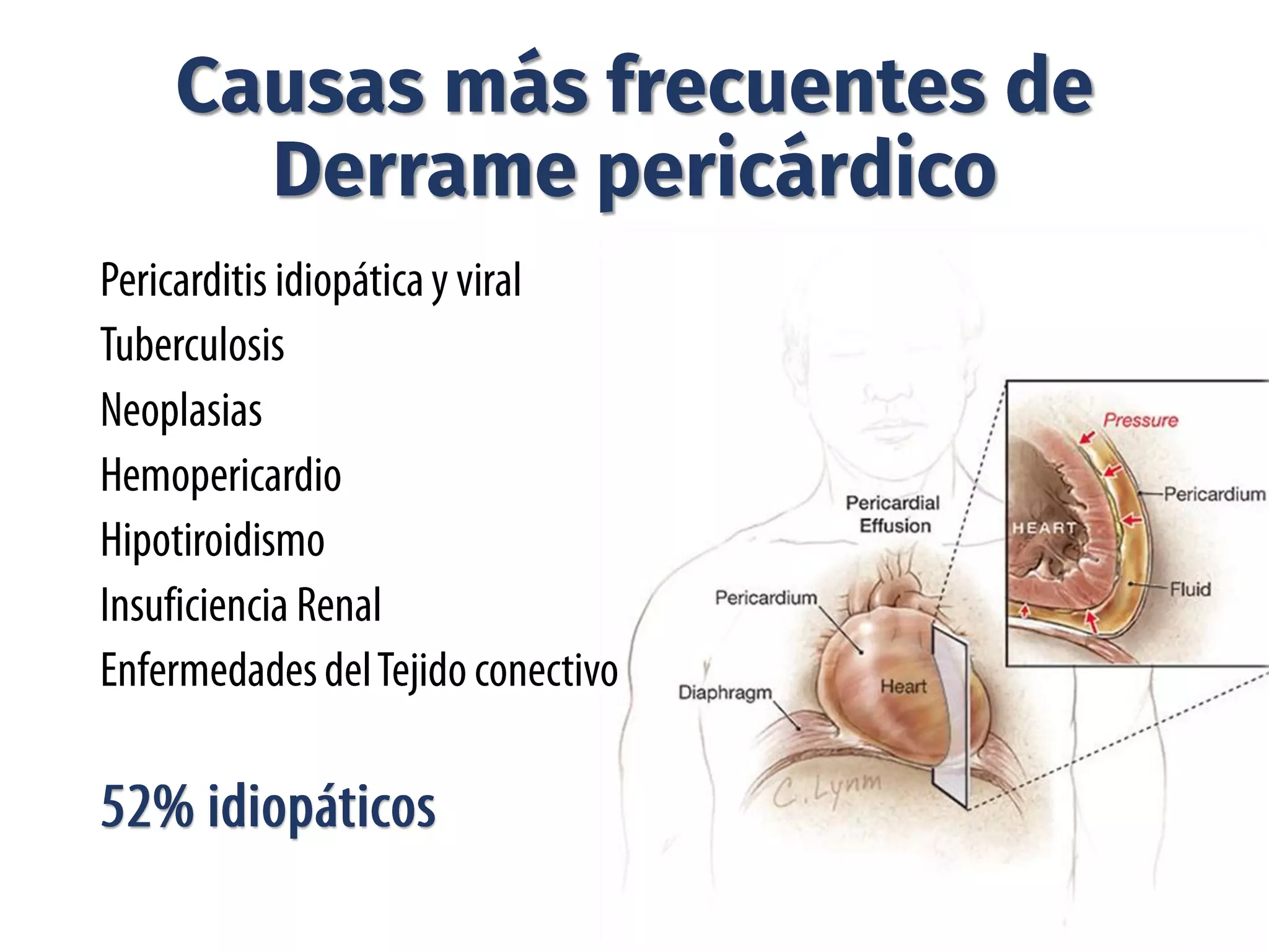 Derrame pericardico y taponamiento cardiaco | PDF