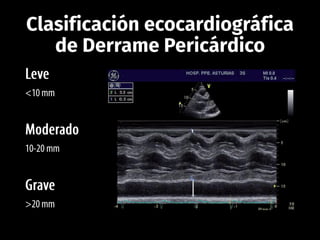 Derrame pericardico y taponamiento cardiaco | PDF